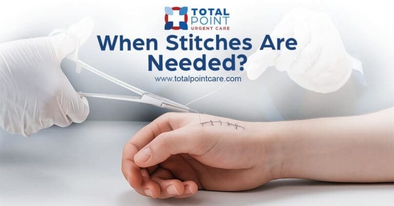 Can Urgent Care Centers Give Stitches? Your Guide to Getting Stitches ...